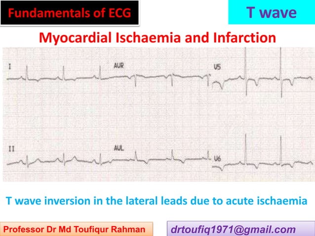 Approach to a patient with T wave abnormality in ECG