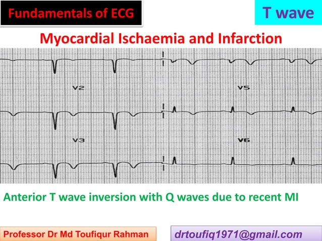Approach to a patient with T wave abnormality in ECG