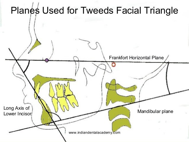 Tweed’s analysis /certified fixed orthodontic courses by Indian denta…