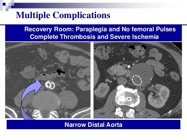 Twenty years of evar in the us the procedure that changed a specialty