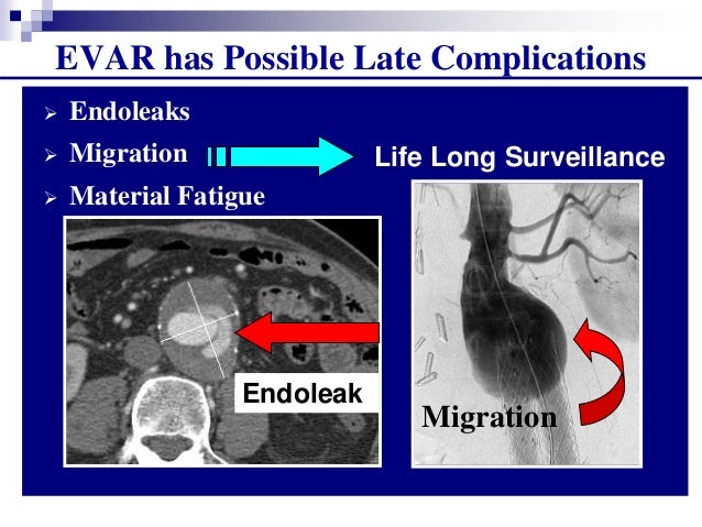 Twenty years of evar in the us the procedure that changed a specialty