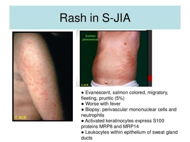 RDD Conf Day 1:Precision medicine for Childhood Arthritis: Marinka Tw…