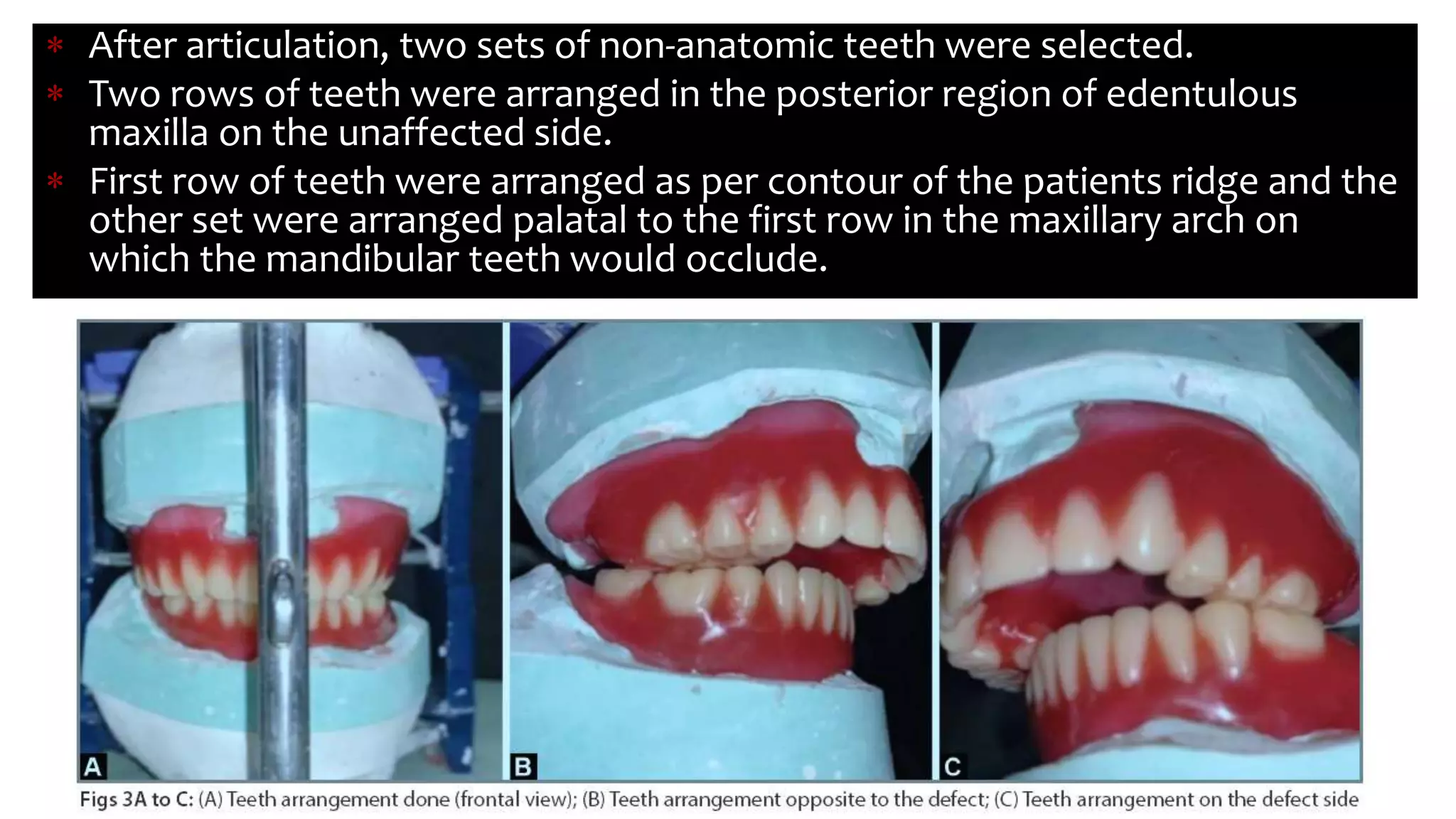Twin occlusion prosthesis in a class 3 | PPTX