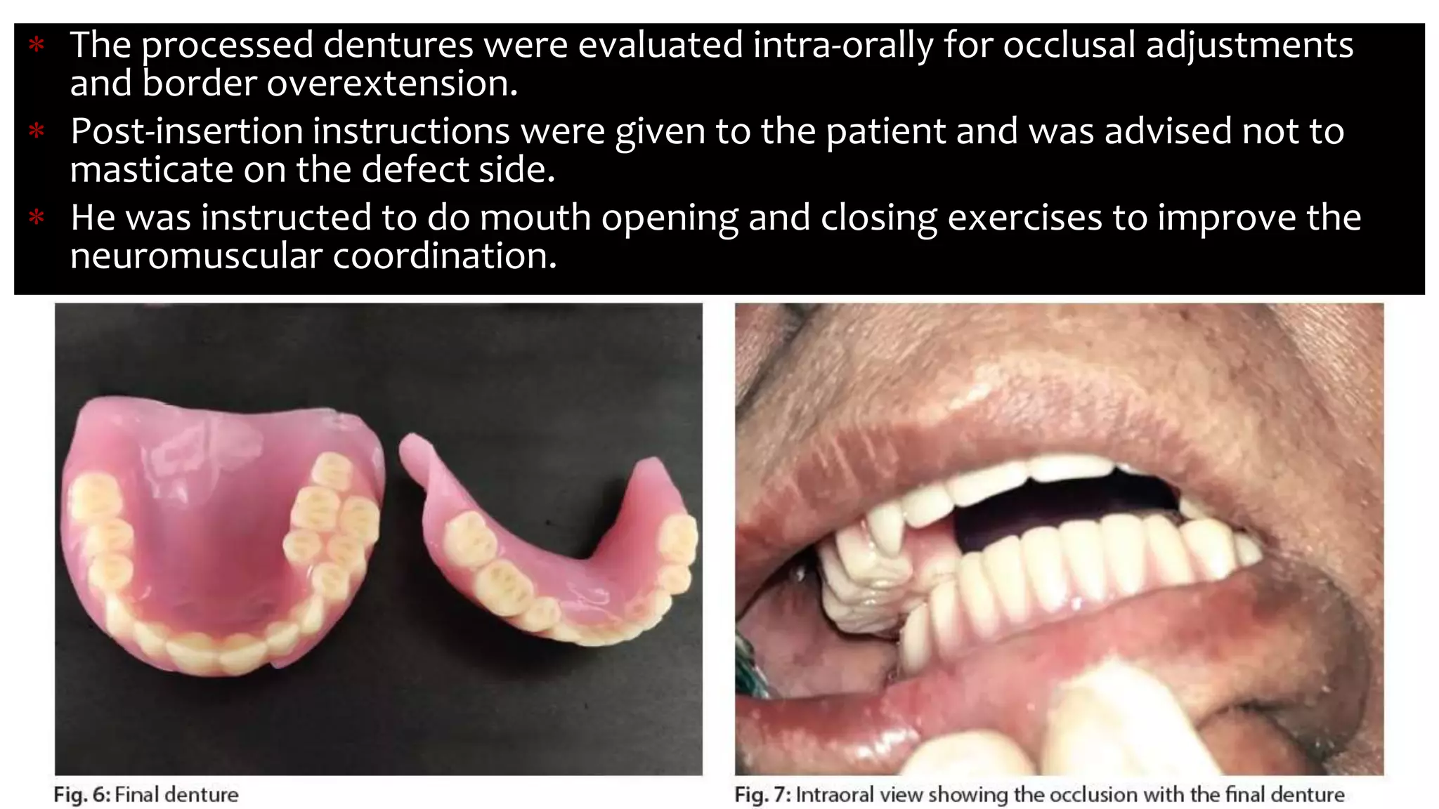 Twin occlusion prosthesis in a class 3 | PPTX