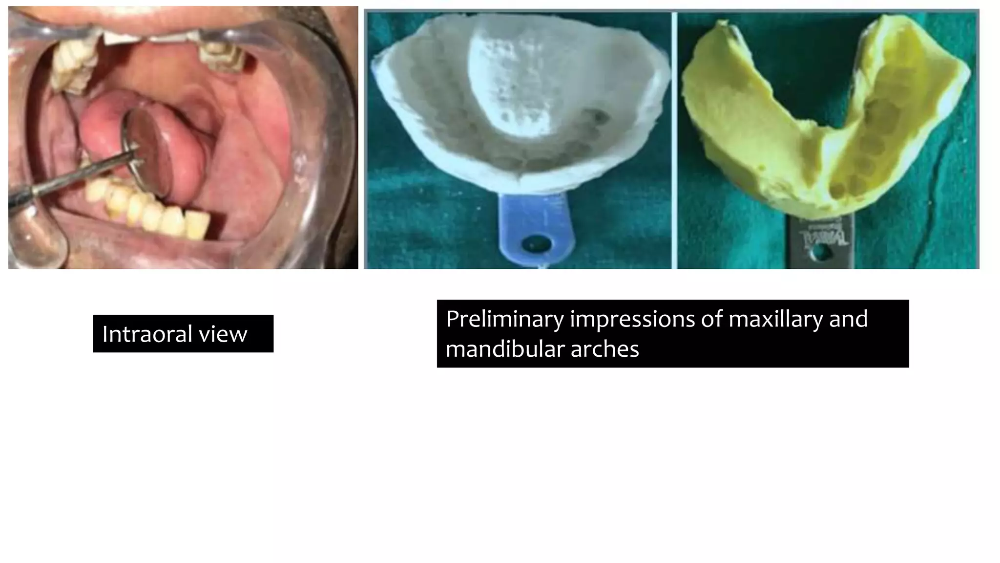 Twin occlusion prosthesis in a class 3 | PPTX