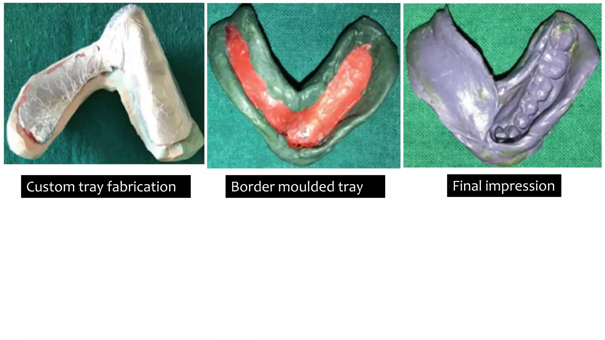 Twin occlusion prosthesis in a class 3 | PPTX