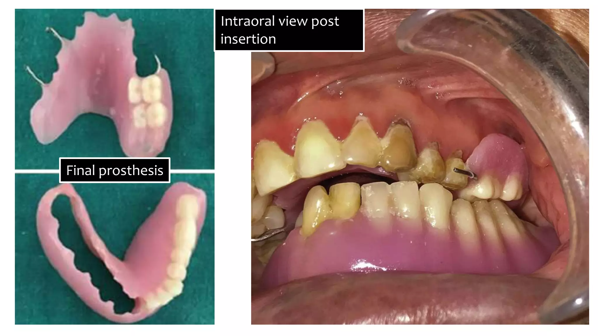 Twin occlusion prosthesis in a class 3 | PPTX
