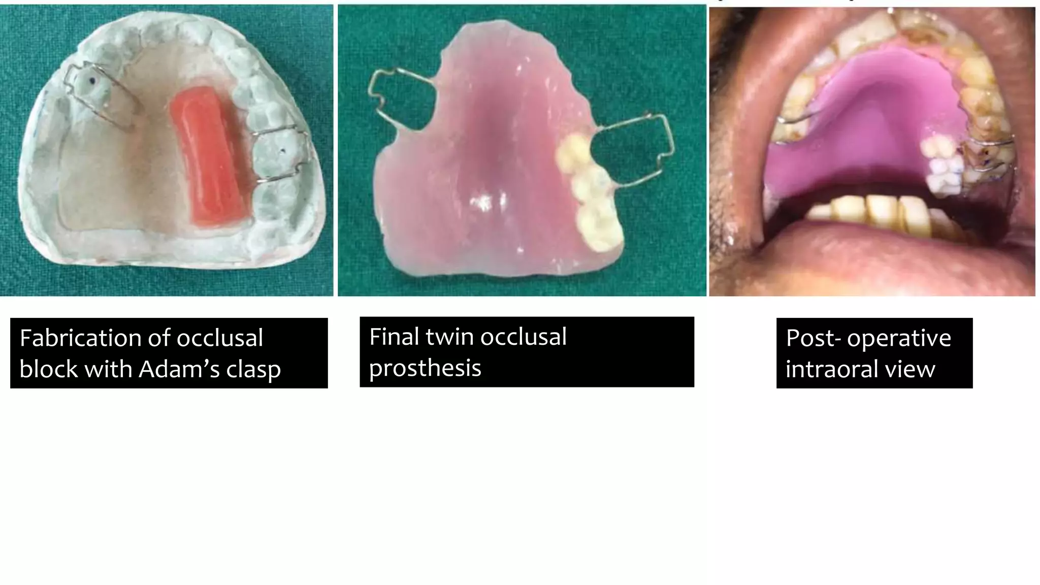 Twin occlusion prosthesis in a class 3 | PPTX