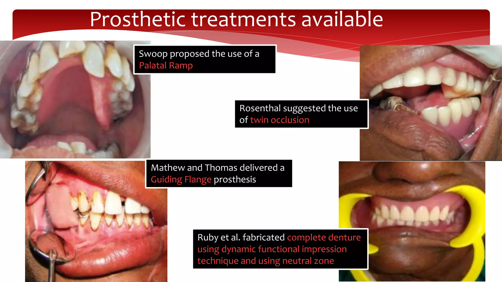 Twin occlusion prosthesis in a class 3 | PPTX