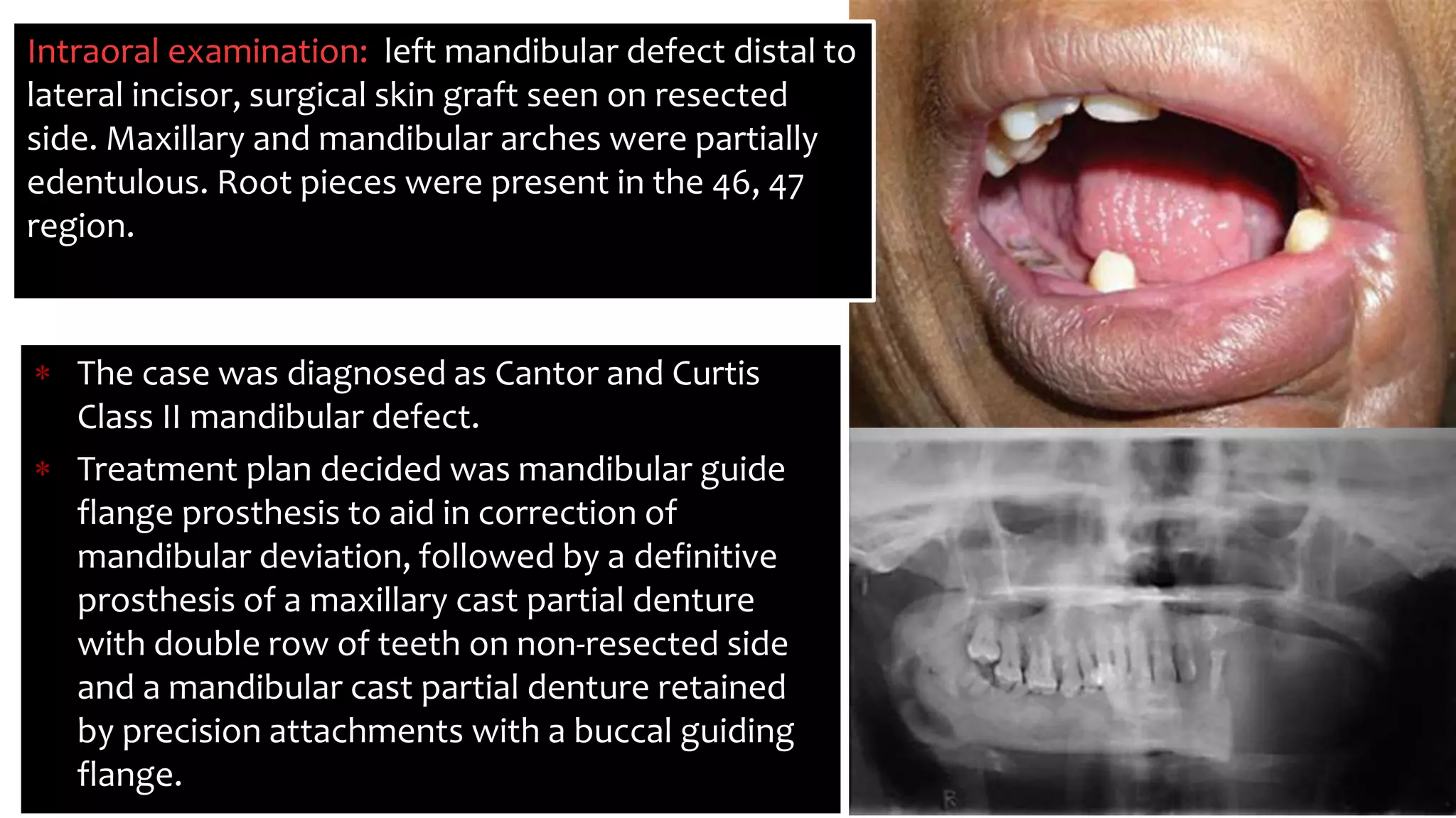 Twin occlusion prosthesis in a class 3 | PPTX