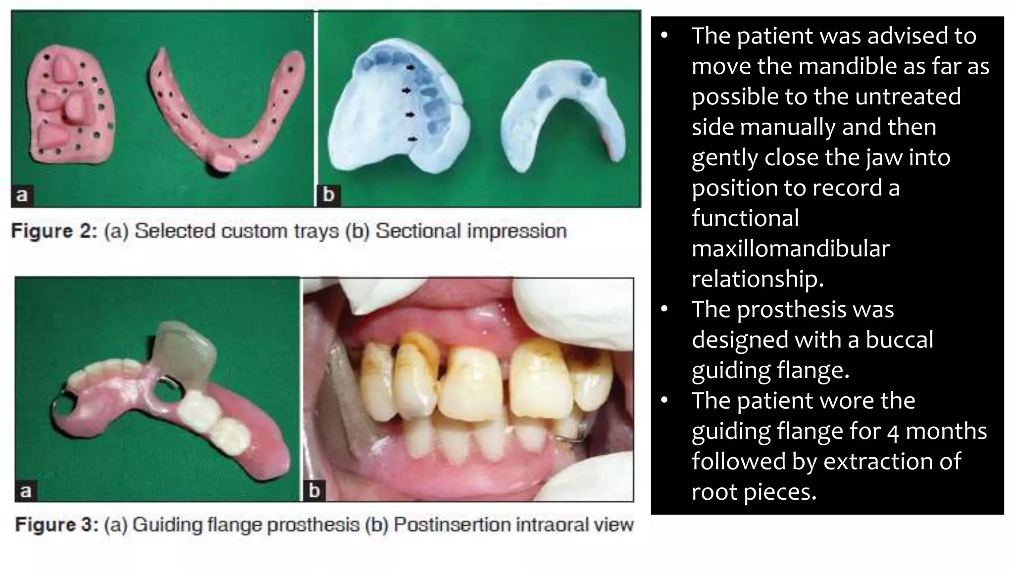 Twin occlusion prosthesis in a class 3 | PPTX