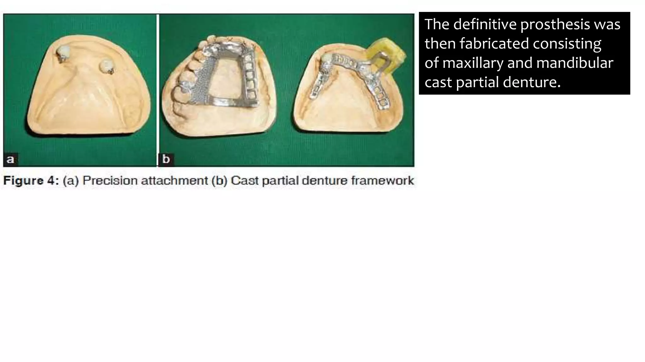 Twin occlusion prosthesis in a class 3 | PPTX
