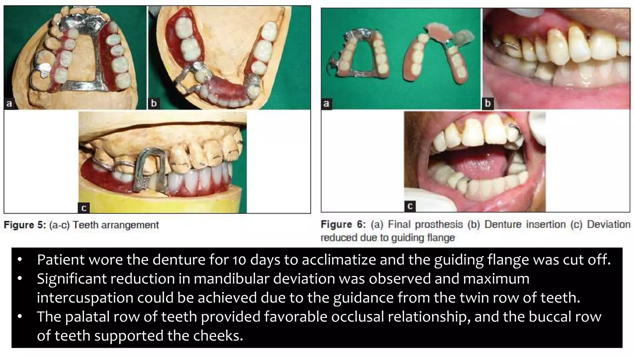 Twin occlusion prosthesis in a class 3 | PPTX