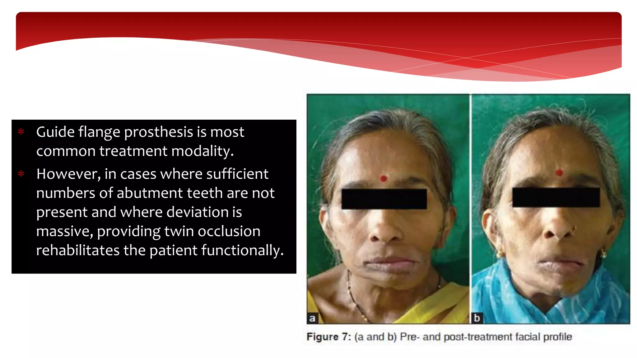 Twin occlusion prosthesis in a class 3 | PPTX