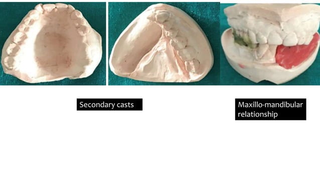 Twin occlusion prosthesis in a class 3 | PPTX | Oral care | Personal Care