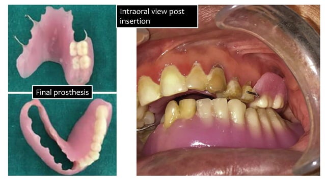 Twin occlusion prosthesis in a class 3 | PPTX | Oral care | Personal Care