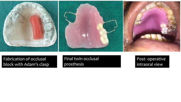 Twin occlusion prosthesis in a class 3 | PPTX | Oral care | Personal Care
