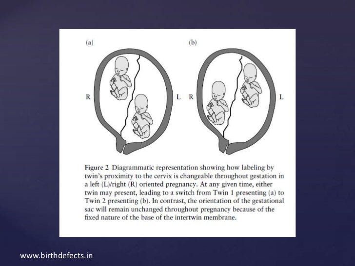 Twin pregnancy....a journey.....