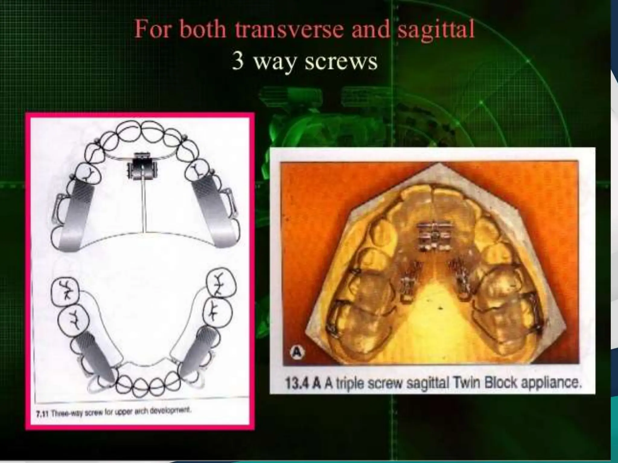 Twin Block appliance in orthodontics .pptx