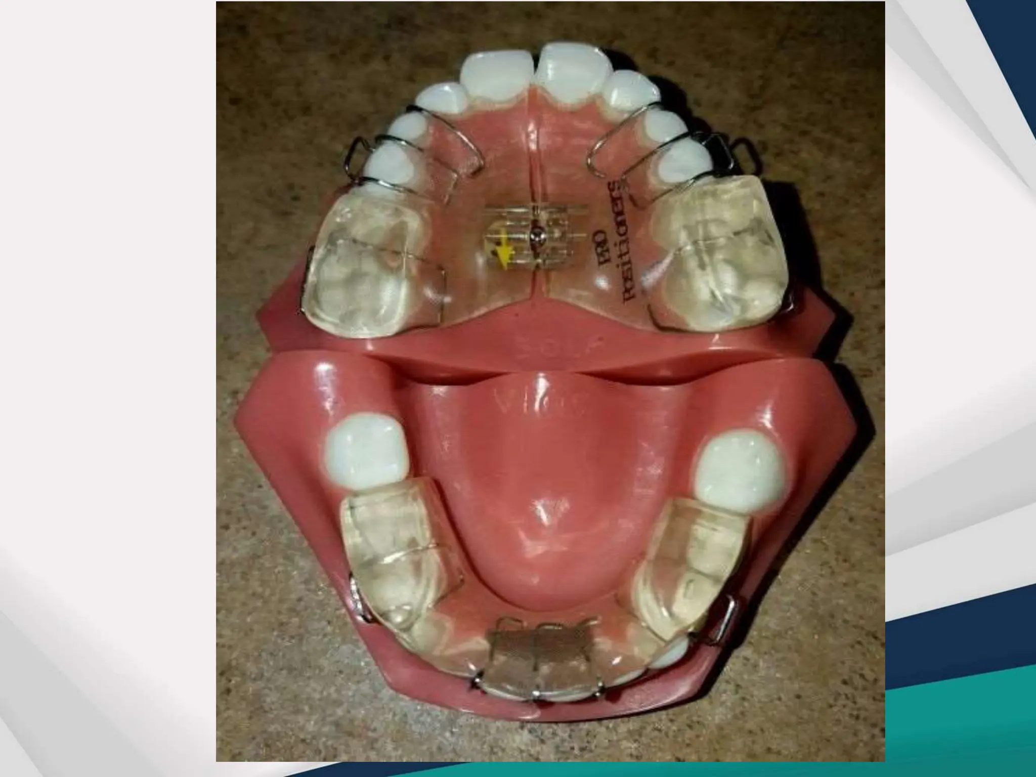 Twin Block appliance in orthodontics .pptx