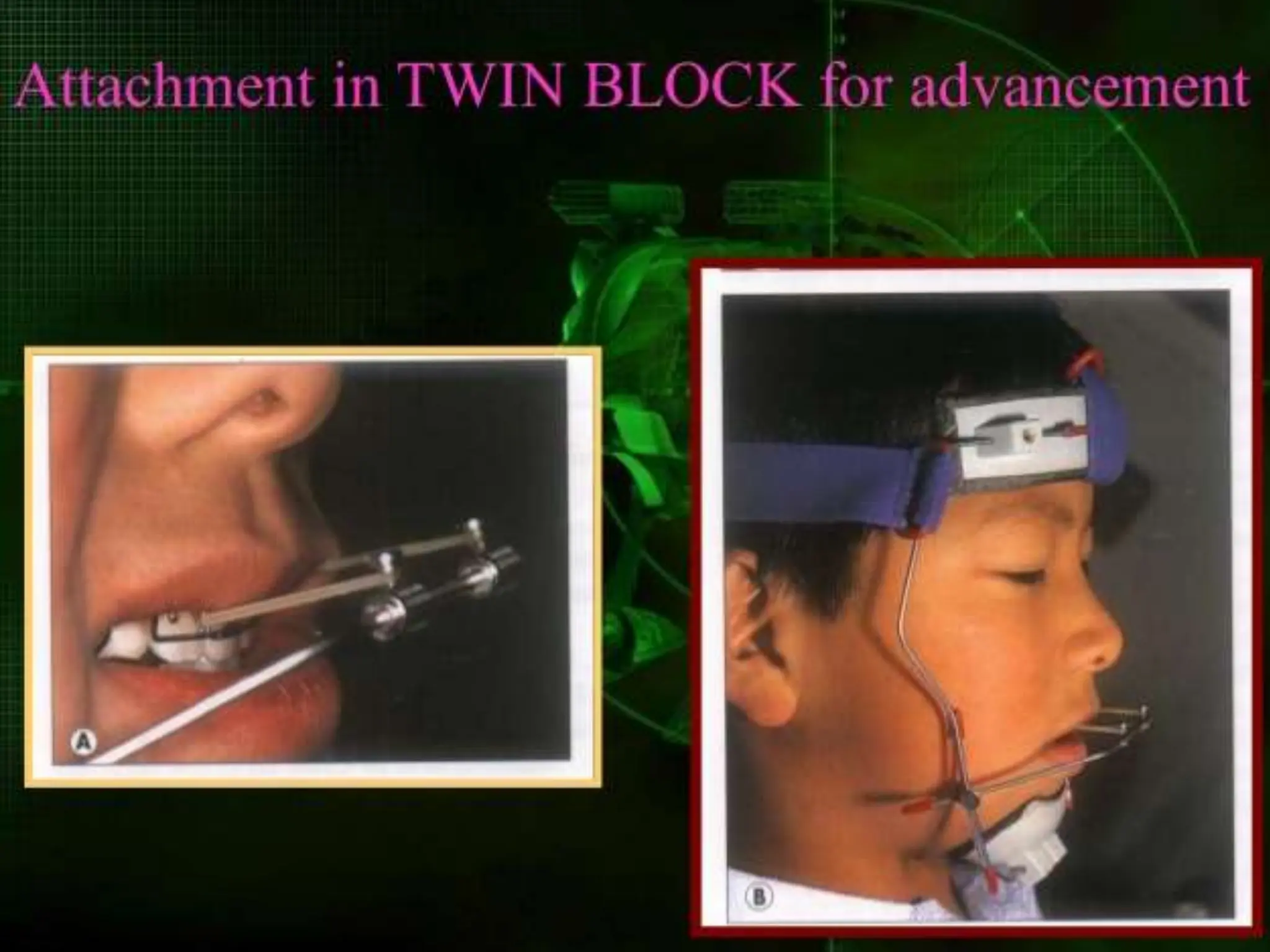 Twin Block appliance in orthodontics .pptx