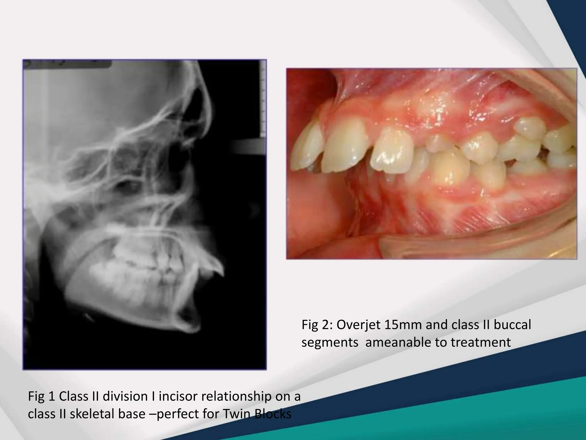 Twin Block appliance in orthodontics .pptx