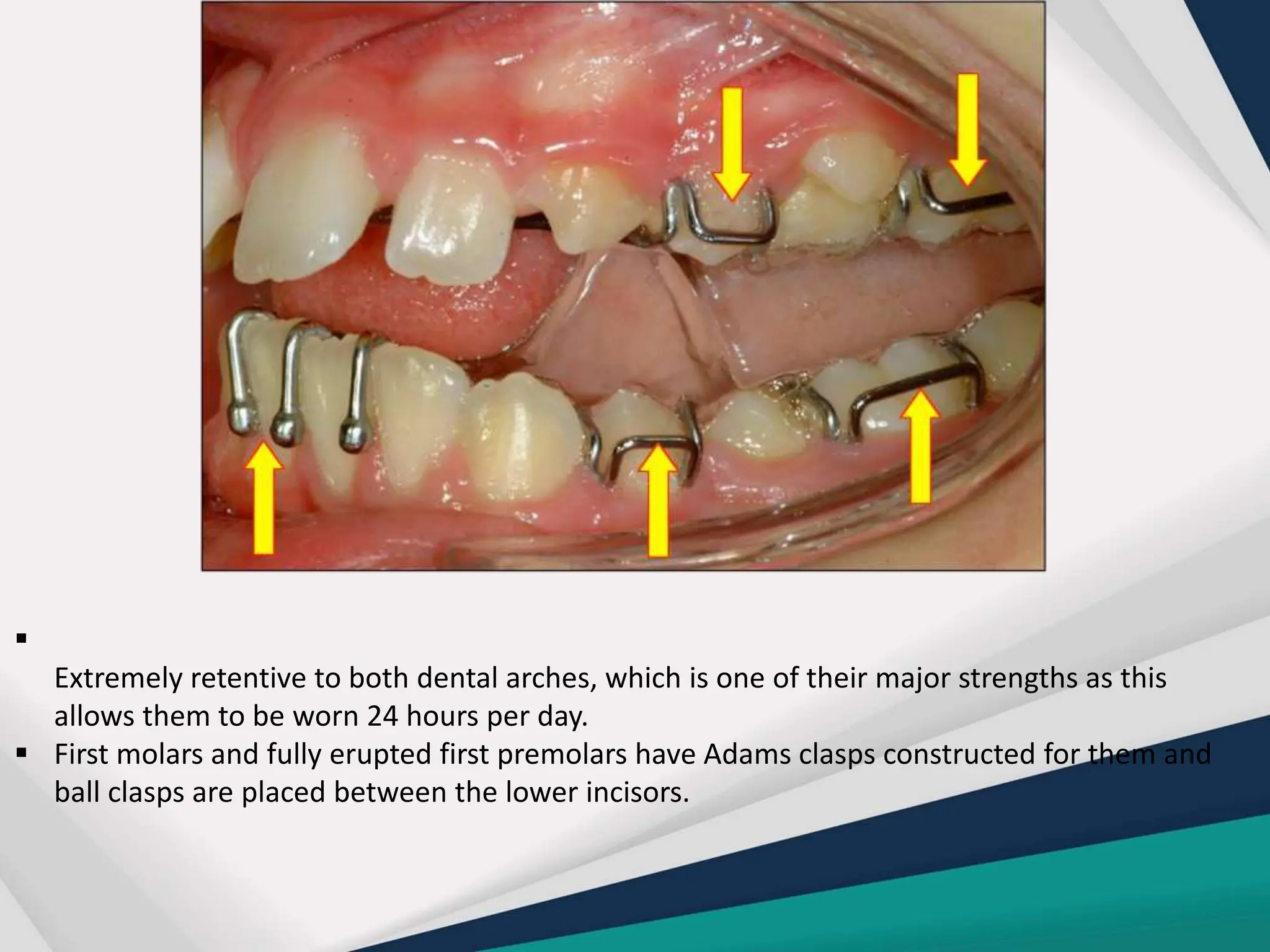 Twin Block appliance in orthodontics .pptx