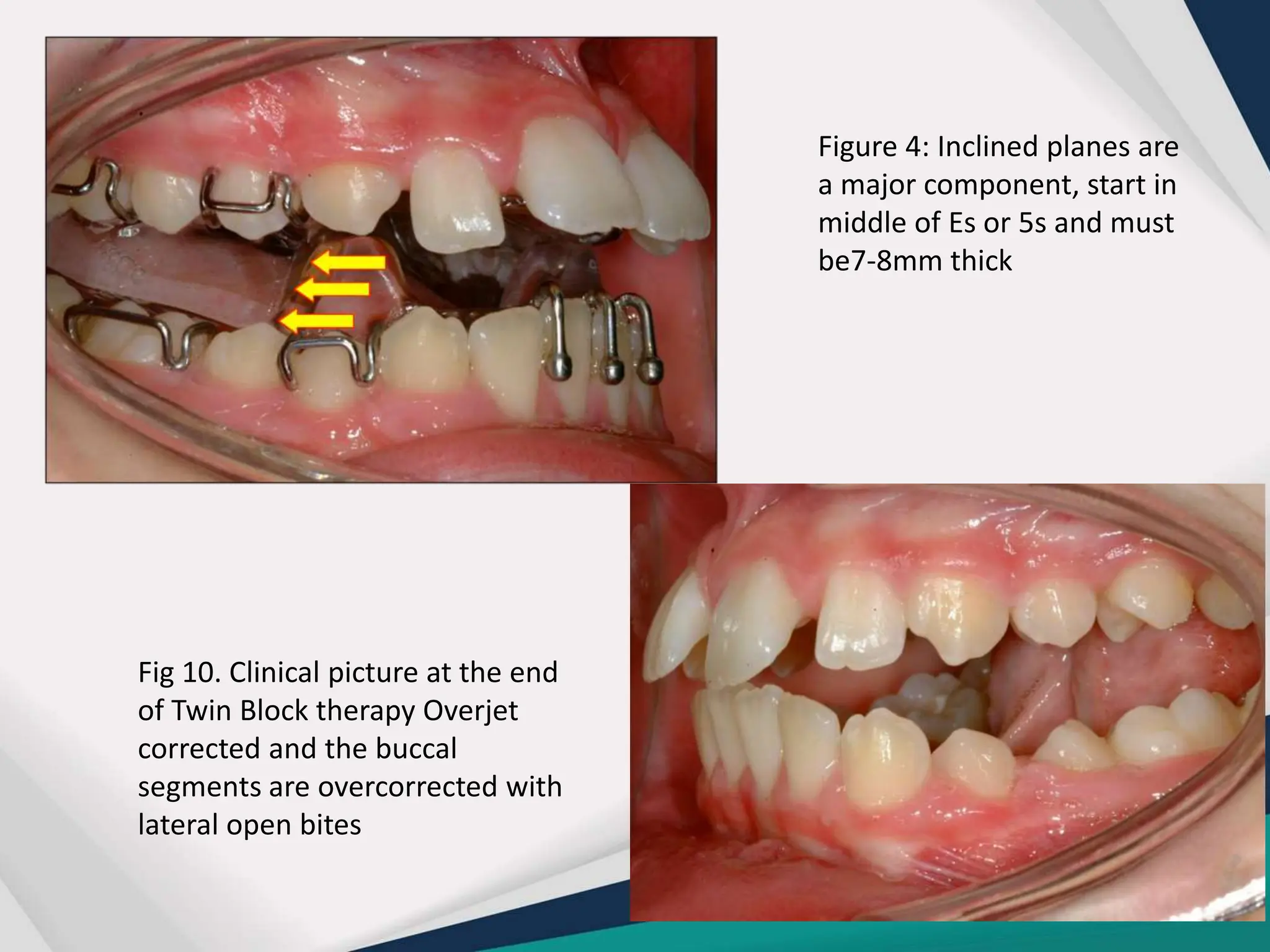 Twin Block appliance in orthodontics .pptx
