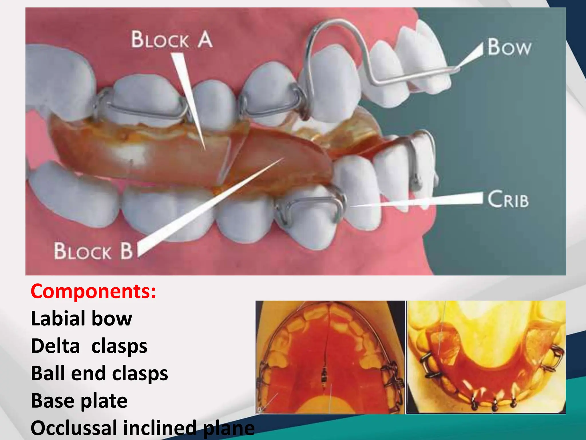 Twin Block appliance in orthodontics .pptx
