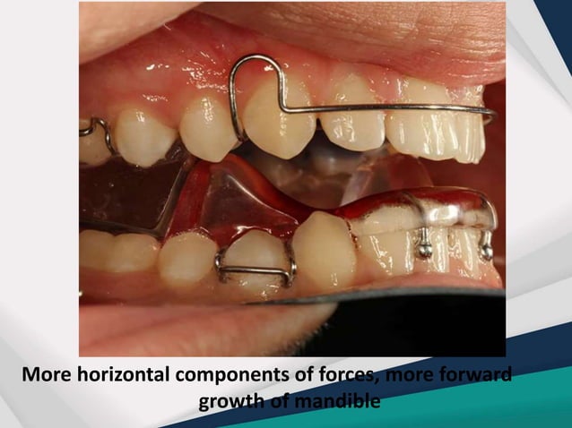 Twin Block appliance in orthodontics .pptx | Dental Health | Diseases ...