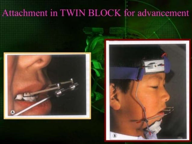Twin Block appliance in orthodontics .pptx | Dental Health | Diseases ...