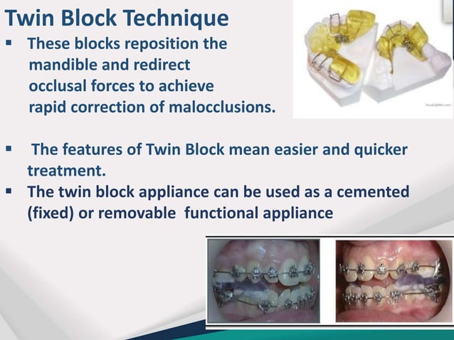 Twin Block appliance in orthodontics .pptx | Dental Health | Diseases ...