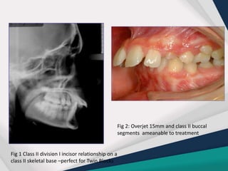 Twin Block appliance in orthodontics .pptx
