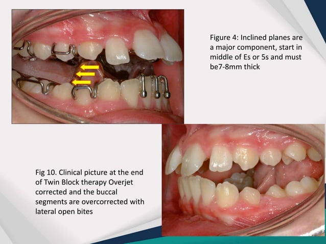 Twin Block appliance in orthodontics .pptx | Dental Health | Diseases ...