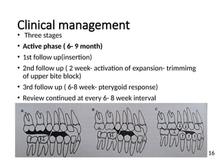 Twin Block appliance(Orthodontics appliance for skeletal correction | PPTX