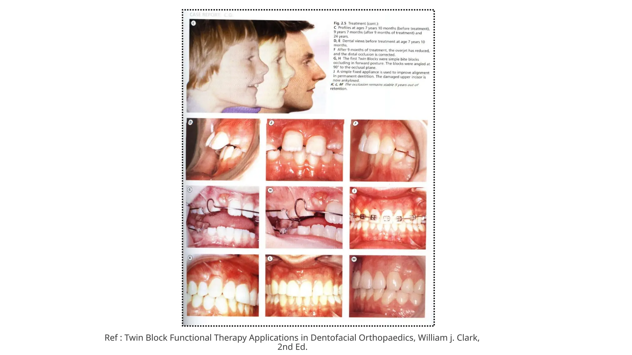 TWIN BLOCK APPLIANCE -A FUNCTIONAL APPLIANCE | PPTX
