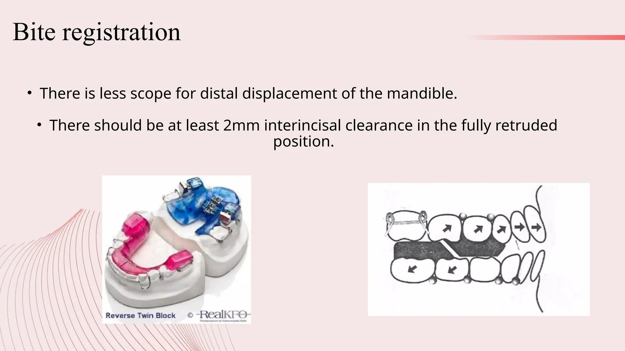 TWIN BLOCK APPLIANCE -A FUNCTIONAL APPLIANCE | PPTX
