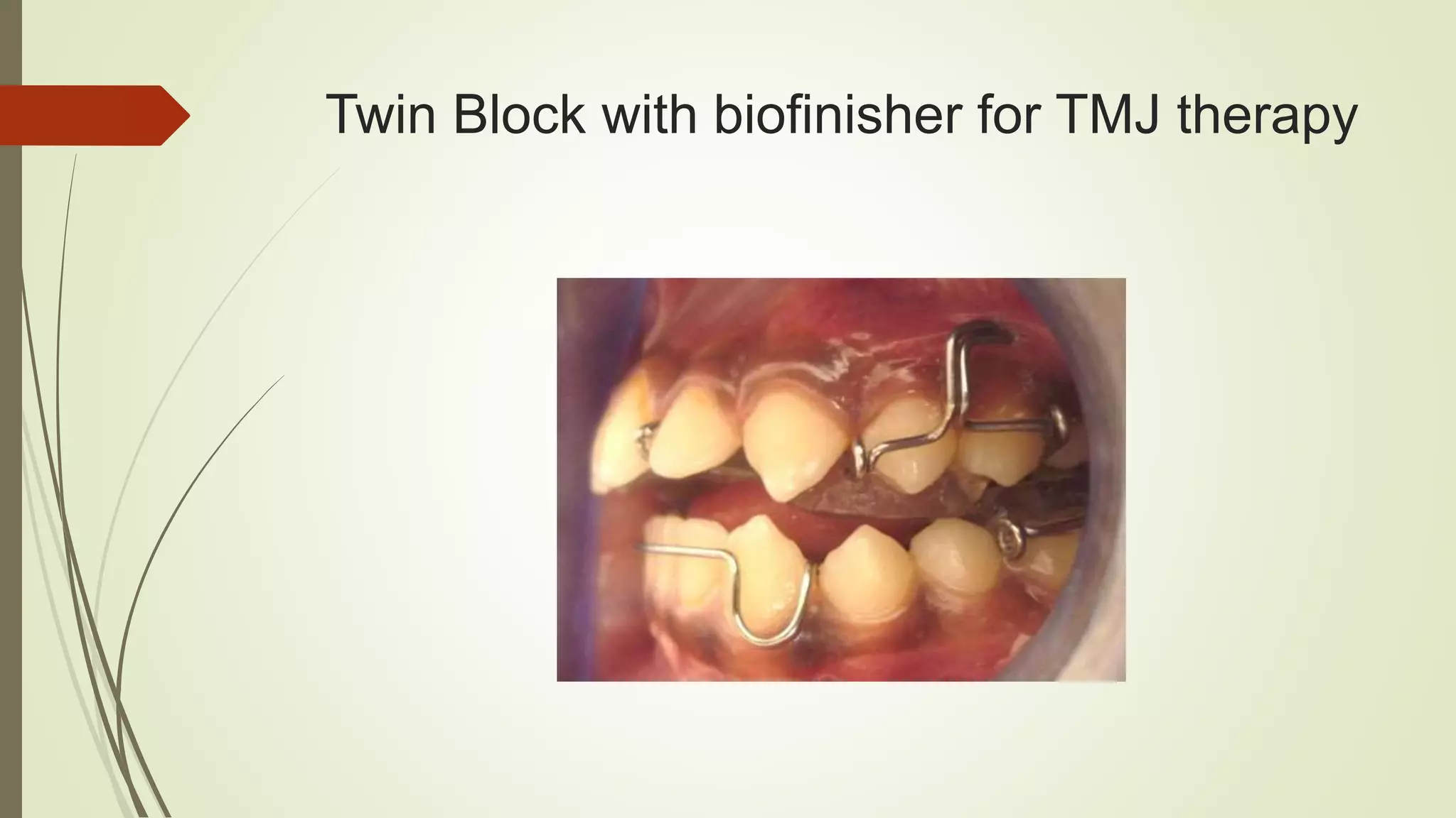 Twin Block Appliance | PPTX
