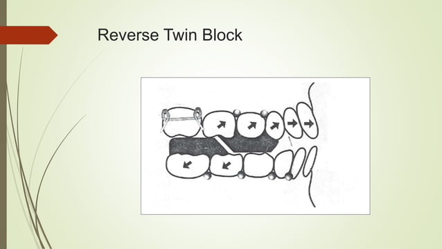 Twin Block Appliance | PPTX