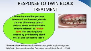 Twin block | PPTX