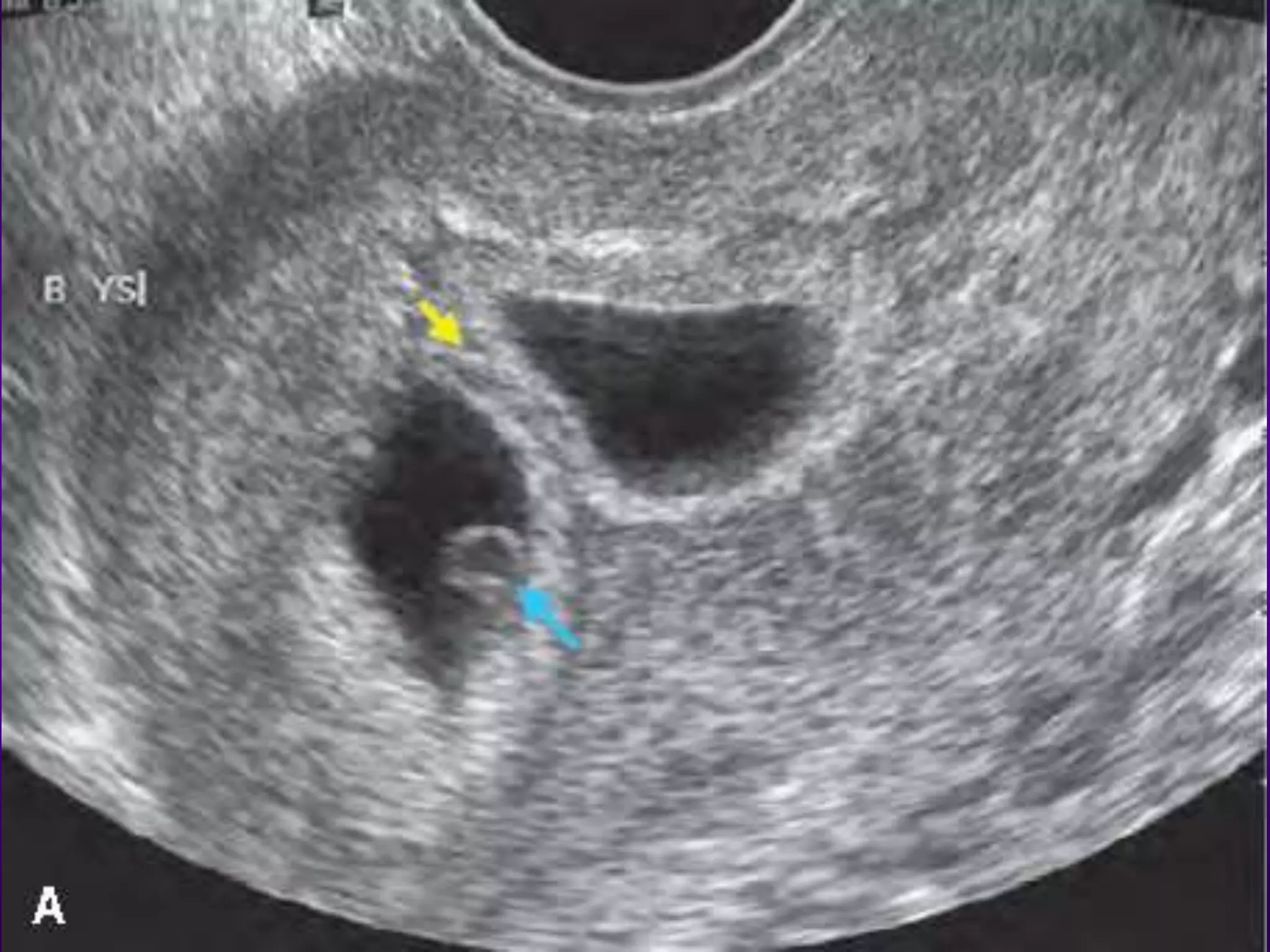 Twin Embolization Syndrome | PPTX