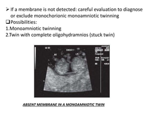 Twin pregnancy-DR.DIVYA JAIN | PPT
