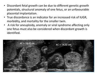 Twin pregnancy-DR.DIVYA JAIN | PPT