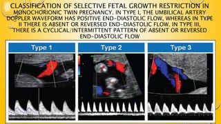Twin pregnancy complicated by selective growth copy - copy (2) - copy ...
