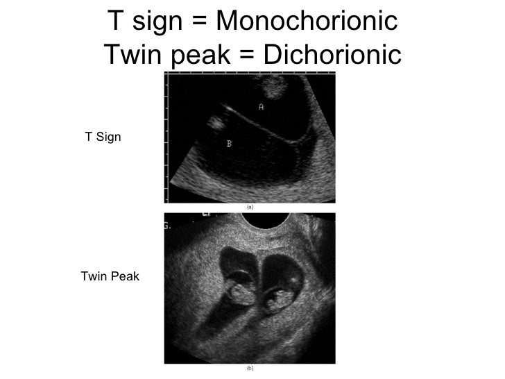 Twin Peaks Sign Ultrasound
