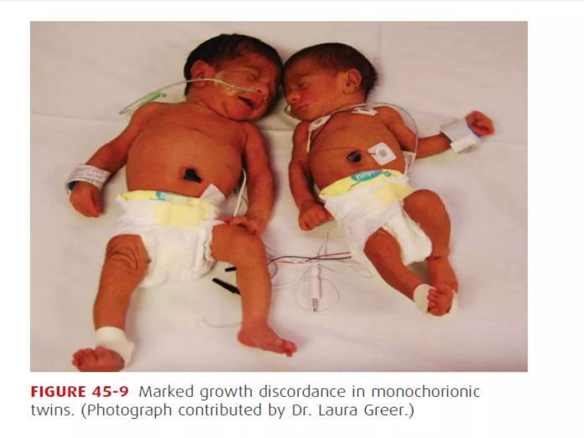 Twins complications | PPTX