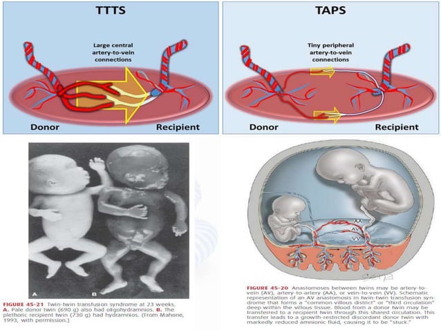 Twins complications | PPTX