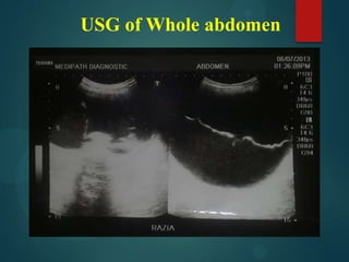 Presentation on Twisted ovarian cyst by Dr. Monnaf | PPT