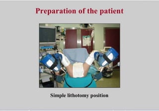 Two stage urethroplasty of bulbar urethra | PPT