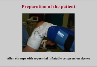 Two stage urethroplasty of bulbar urethra | PPT